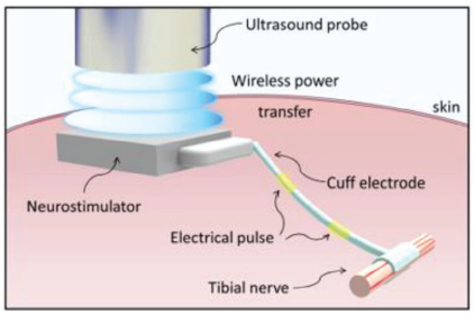 Battery-Free Implants: Powering Bioelectronics By Ultrasound – ACCESS ...